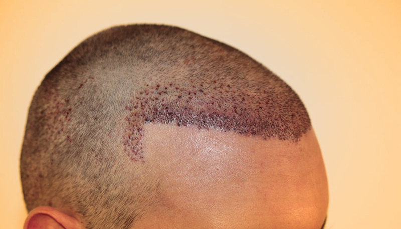 Biaya Cangkok Rambut Terbaru | Info Biaya