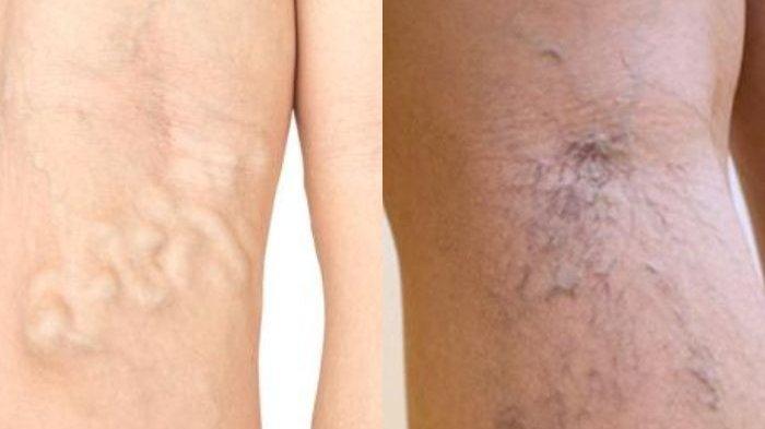 Biaya Untuk Suntik Varises Metode Skleroterapi | Info Biaya